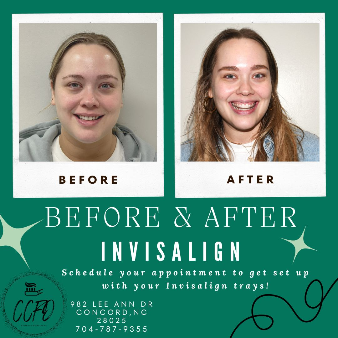 Invisalign Aligners: Everything You Need to Know - Concord Center for ...